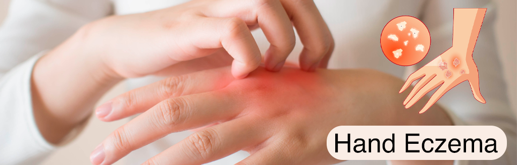 Hand Eczema